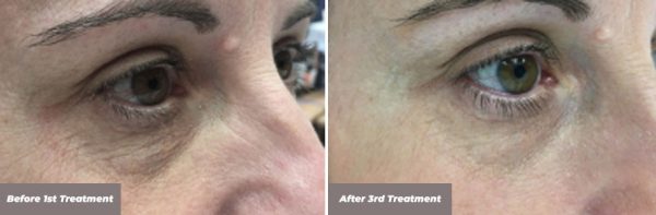 HydraFacial Perk Lip & Eye - €35 | Changes Clinic, Dublin