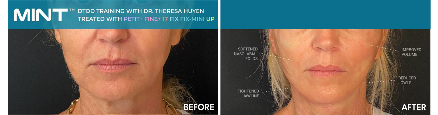 Mint PDO Thread Lift - Changes Clinic, Tallaght, Dublin
