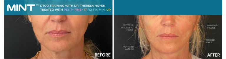Mint PDO Thread Lift - Changes Clinic, Tallaght, Dublin