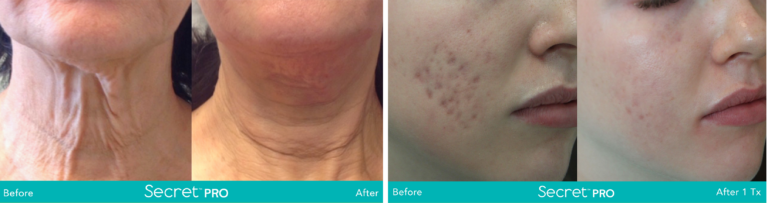 Cutera Secret Pro - Changes Clinic, Tallaght, Dublin